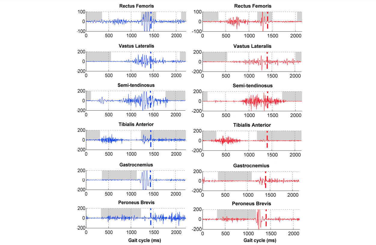 Elsass Foundation: Supporting cerebral palsy patients through EMG ...