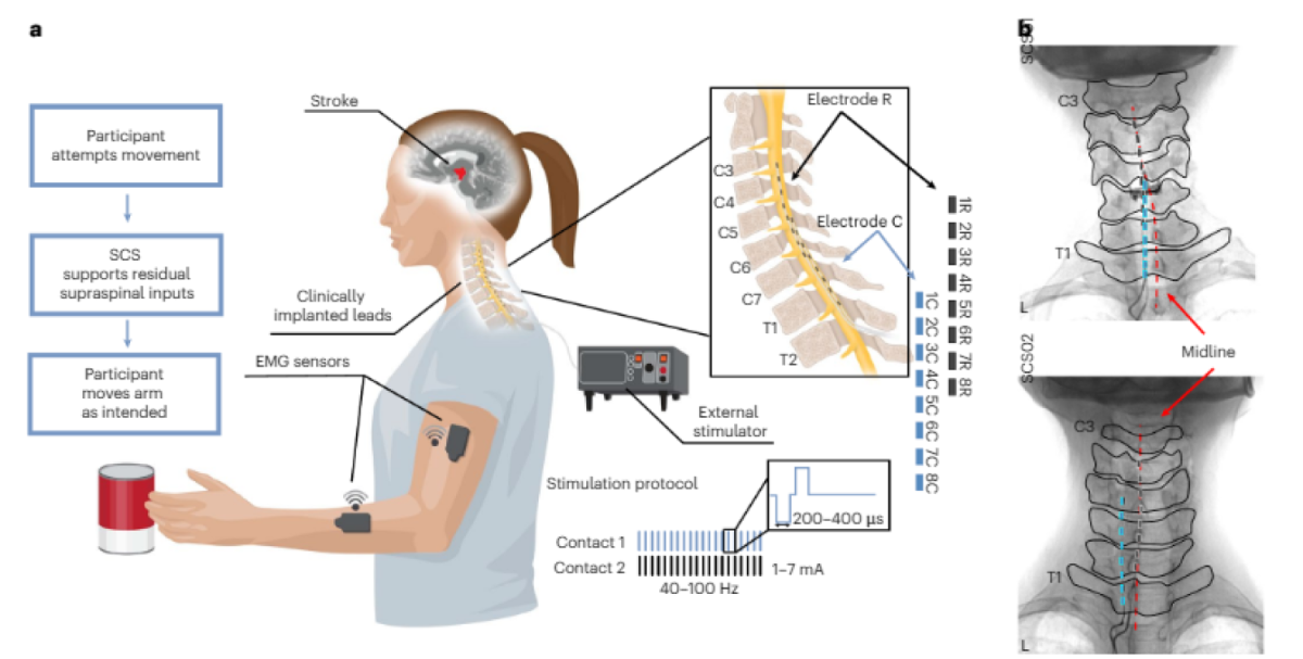 Spinal Cord Stimulation for Stroke Rehabilitation - Delsys